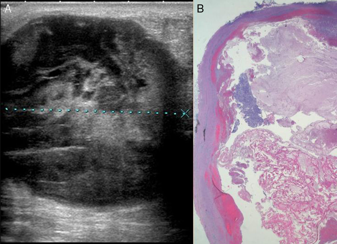 Carcinoma medular quístico de mama | Revista de Senología y Patología ...