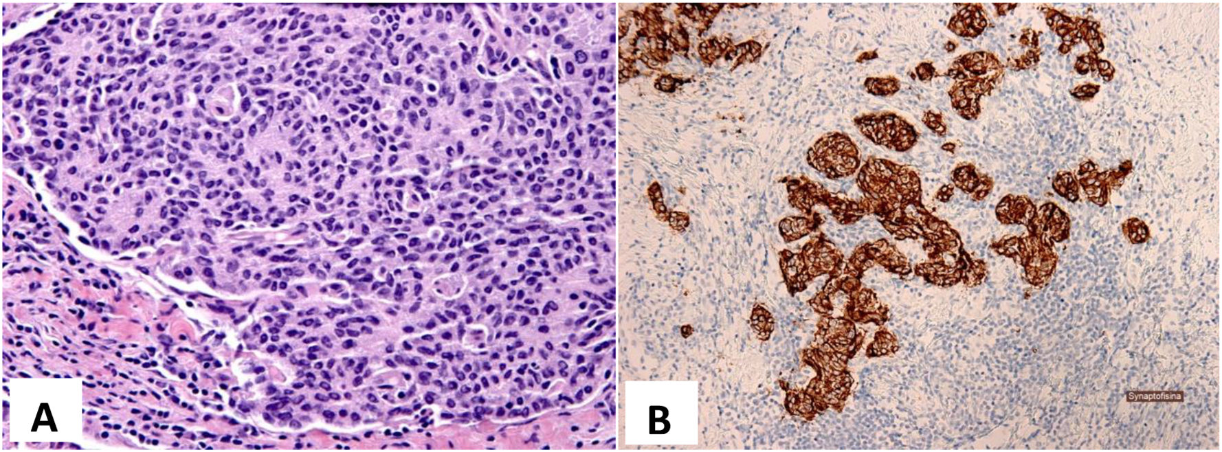 Cáncer neuroendocrino de mama, presentación de un caso y técnicas ...