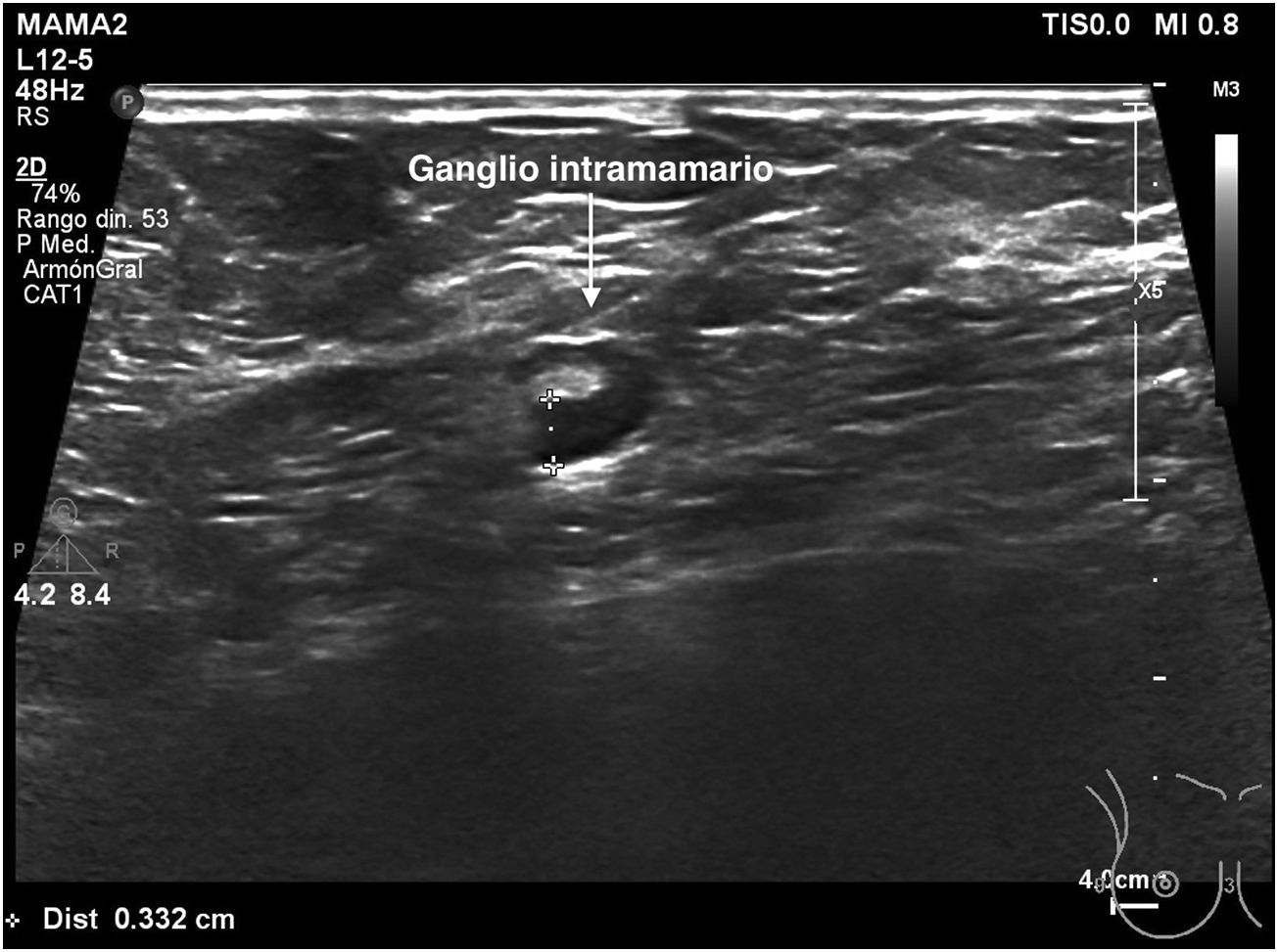 Manejo del ganglio intramamario metastásico en carcinoma de mama ...