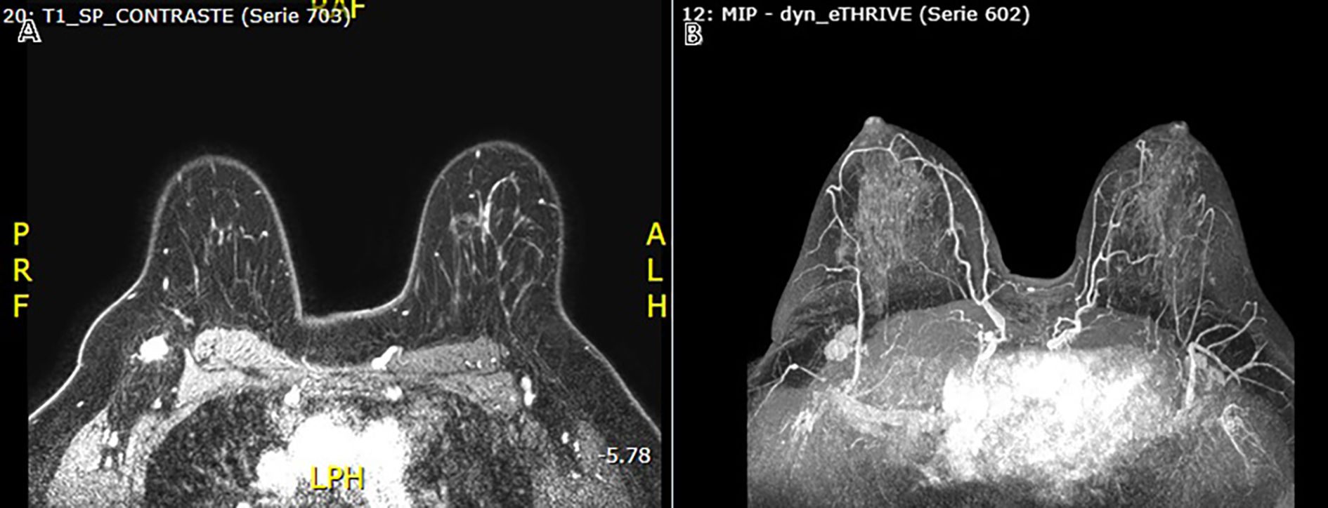 Triple-negative occult breast cancer: A case report | Revista de ...