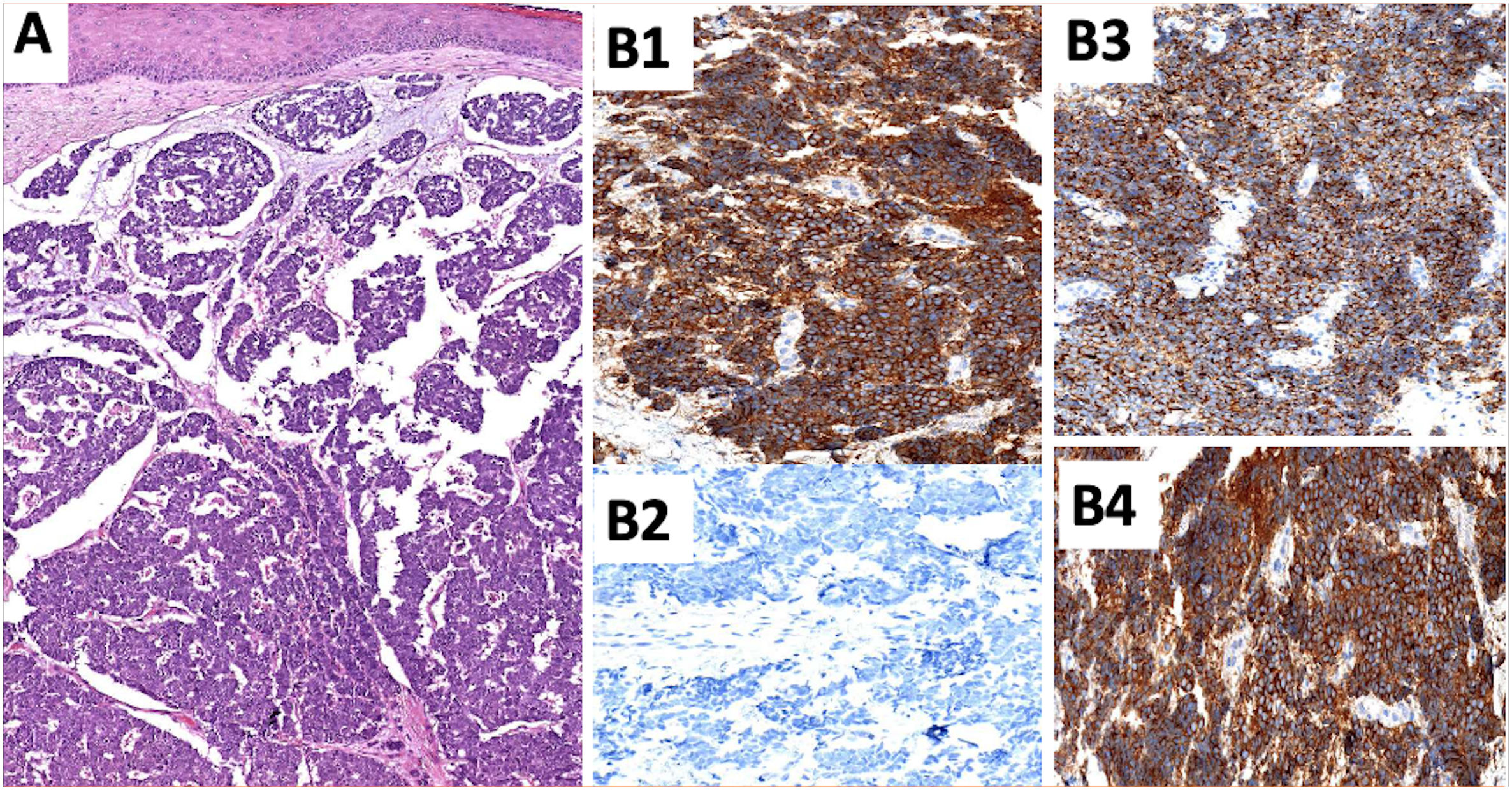 Description of a case: merkel cell carcinoma in a male nipple after a ...