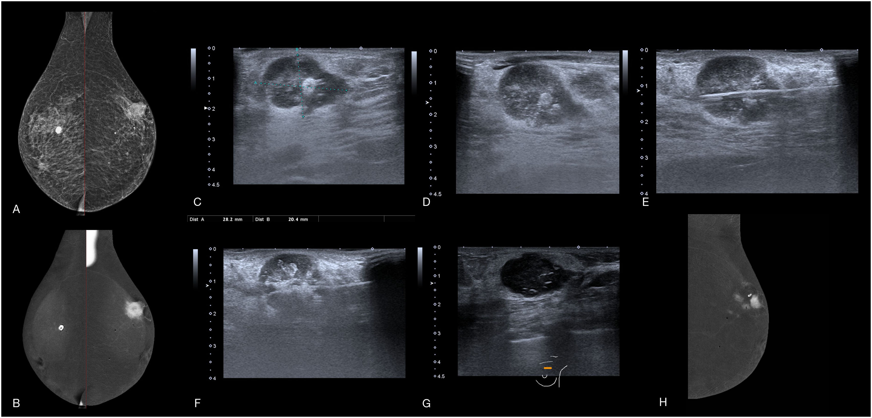 Ablación percutánea con microondas guiada por ecografía de tumores de ...