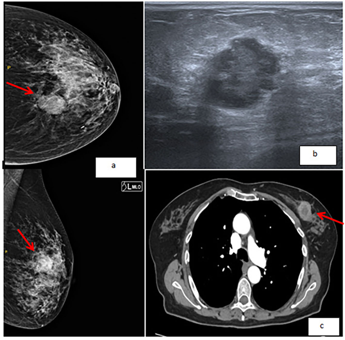Tumor phyllodes maligno asociado a carcinoma ductal infiltrante de la ...