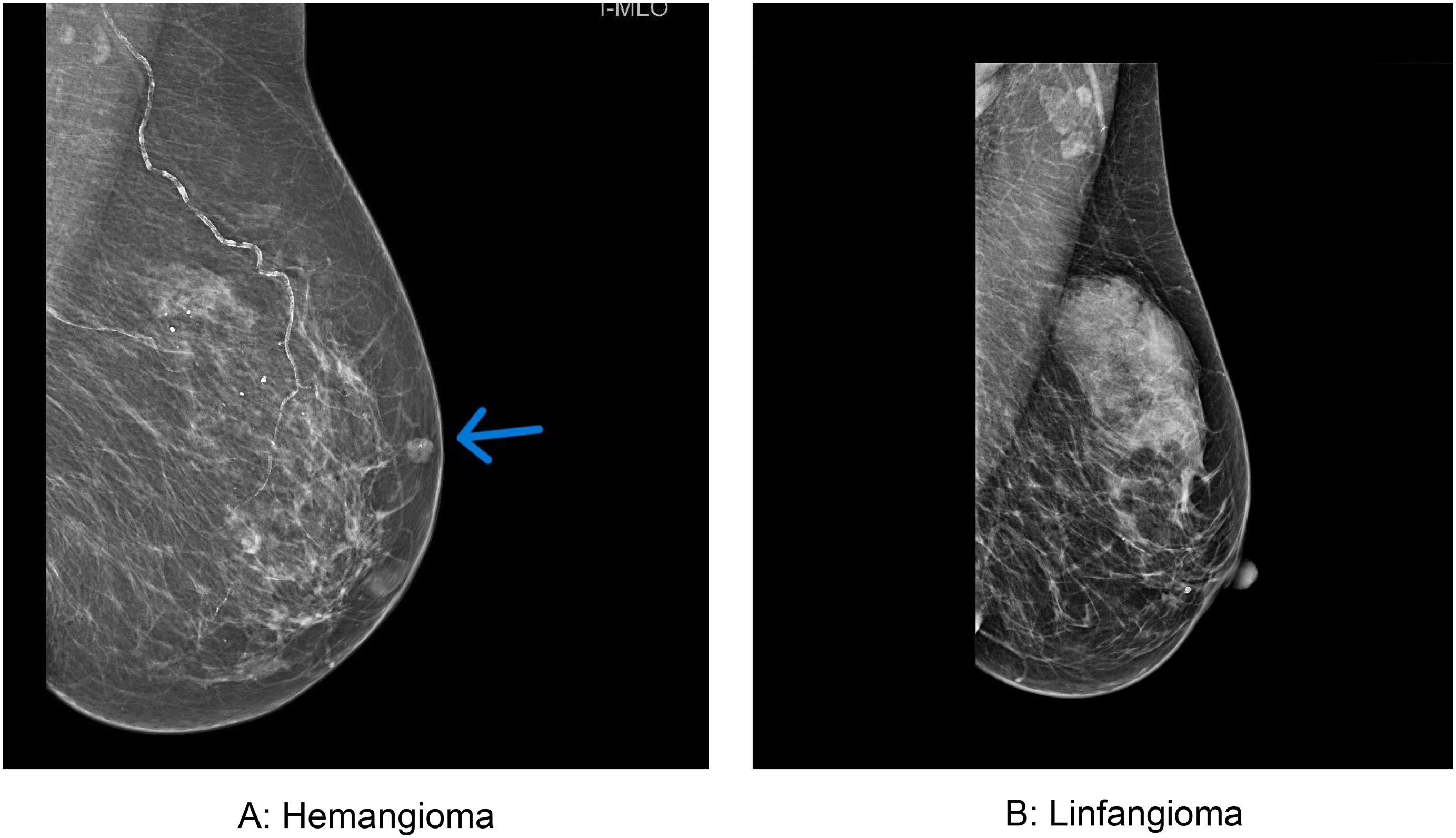 Anomalías vasculares de la mama | Revista de Senología y Patología ...