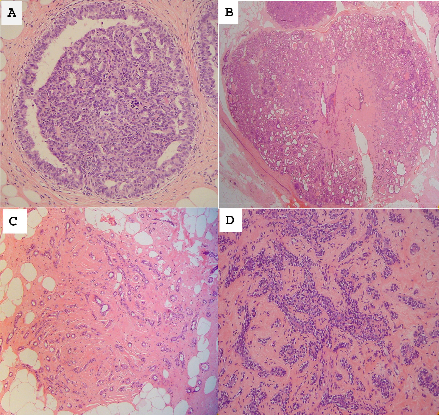 Histological lesions of risk for breast carcinoma. An updated survival ...