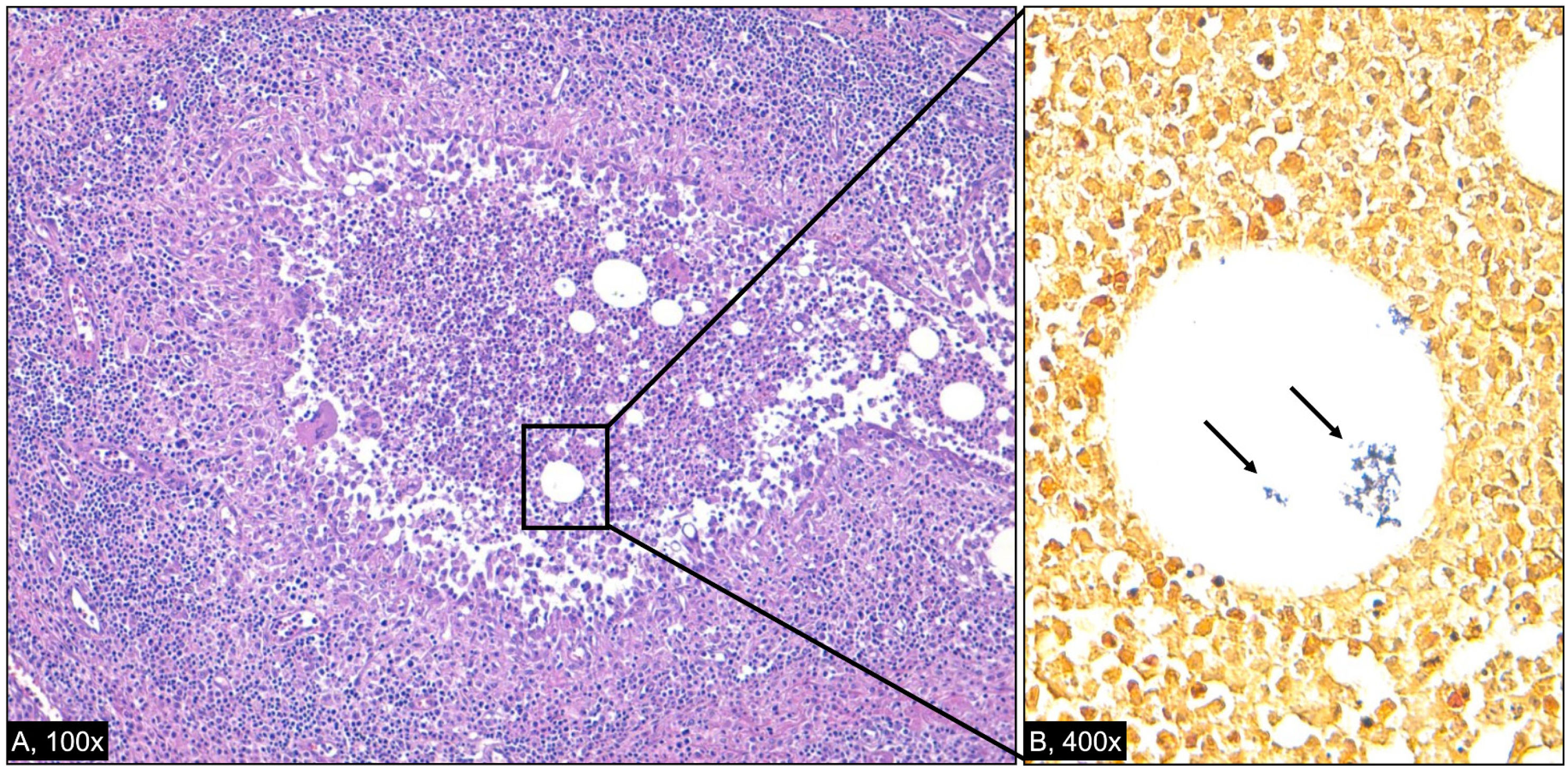 Cystic neutrophilic granulomatous mastitis associated with ...