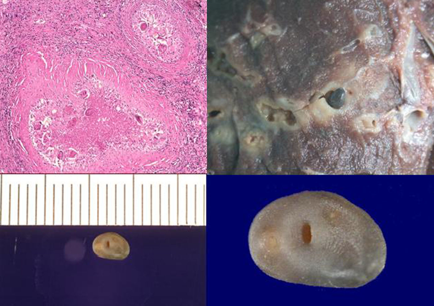 Paragonimiasis pulmonar | Archivos de Bronconeumología