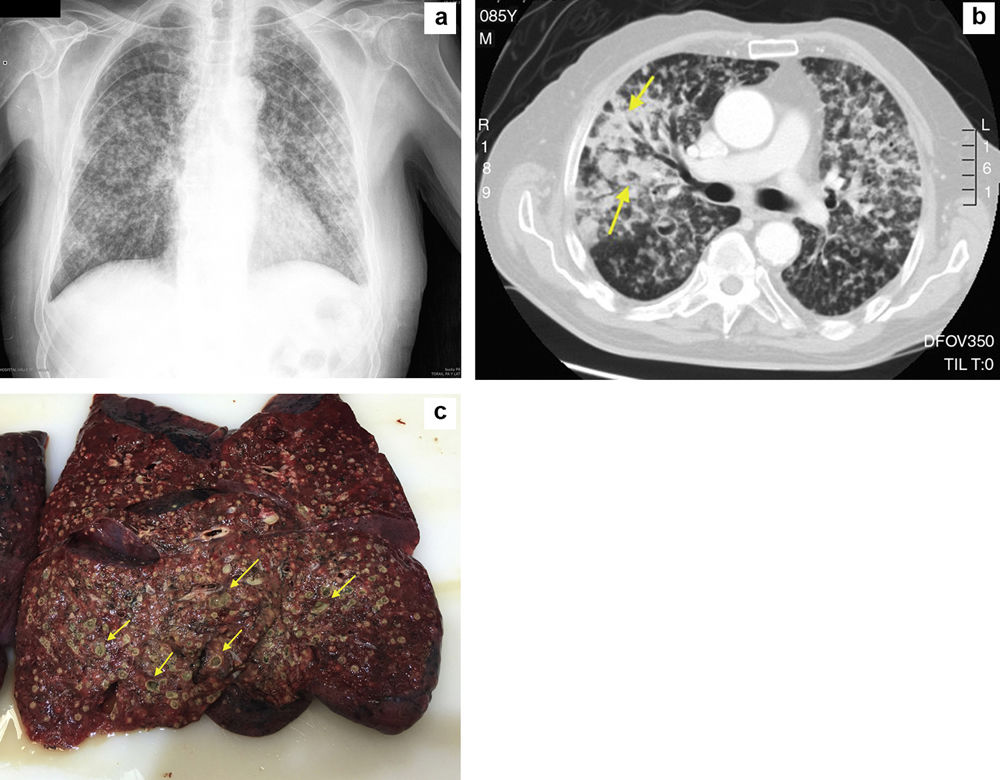 Aspergilosis Pulmonar Invasiva Causada Por Aspergillus Ustus En Un