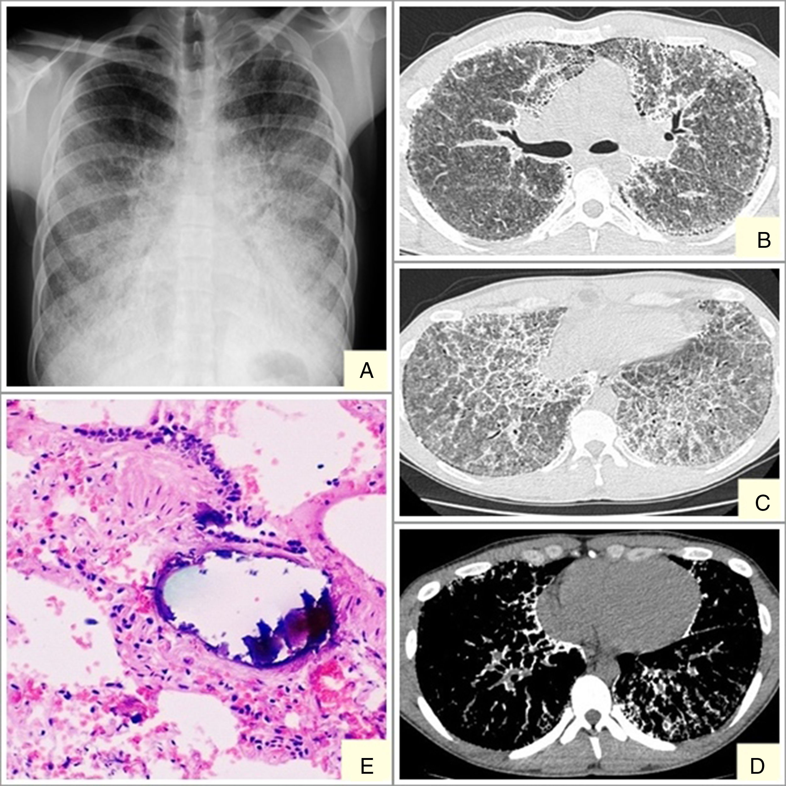 Microlitiasis alveolar y su peculiar disociación clínico-radiológica ...
