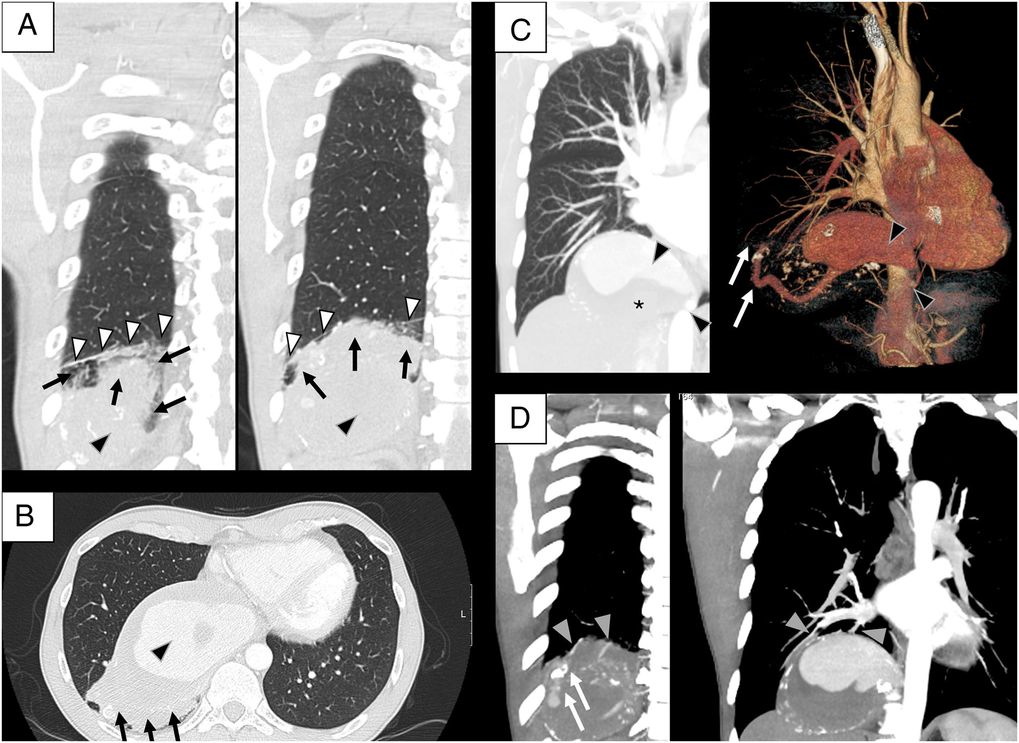 lung parenchyma