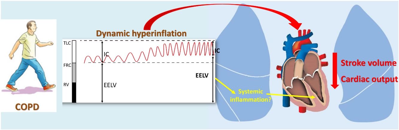 Effect of Dynamic Hyperinflation on Cardiac Response to Exercise of ...