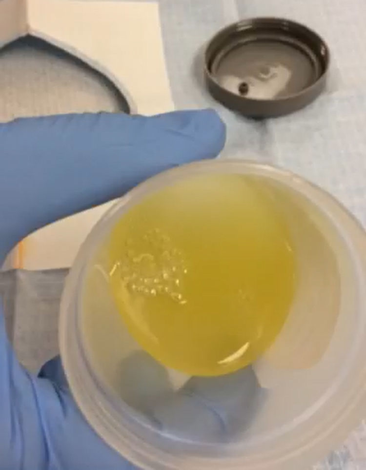 Gelatinous Pleural Fluid With Mesothelioma | Archivos de Bronconeumología