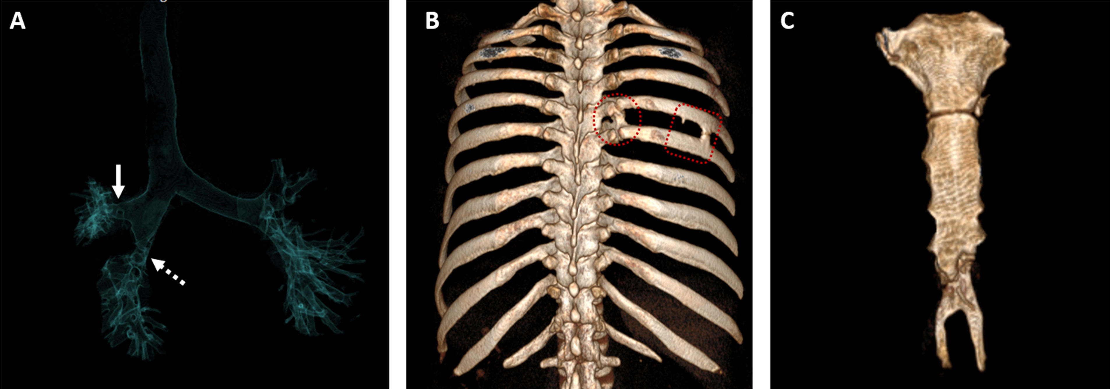 Right Lung Middle Lobe Agenesis and Multiple Bone Anomalies | Archivos ...