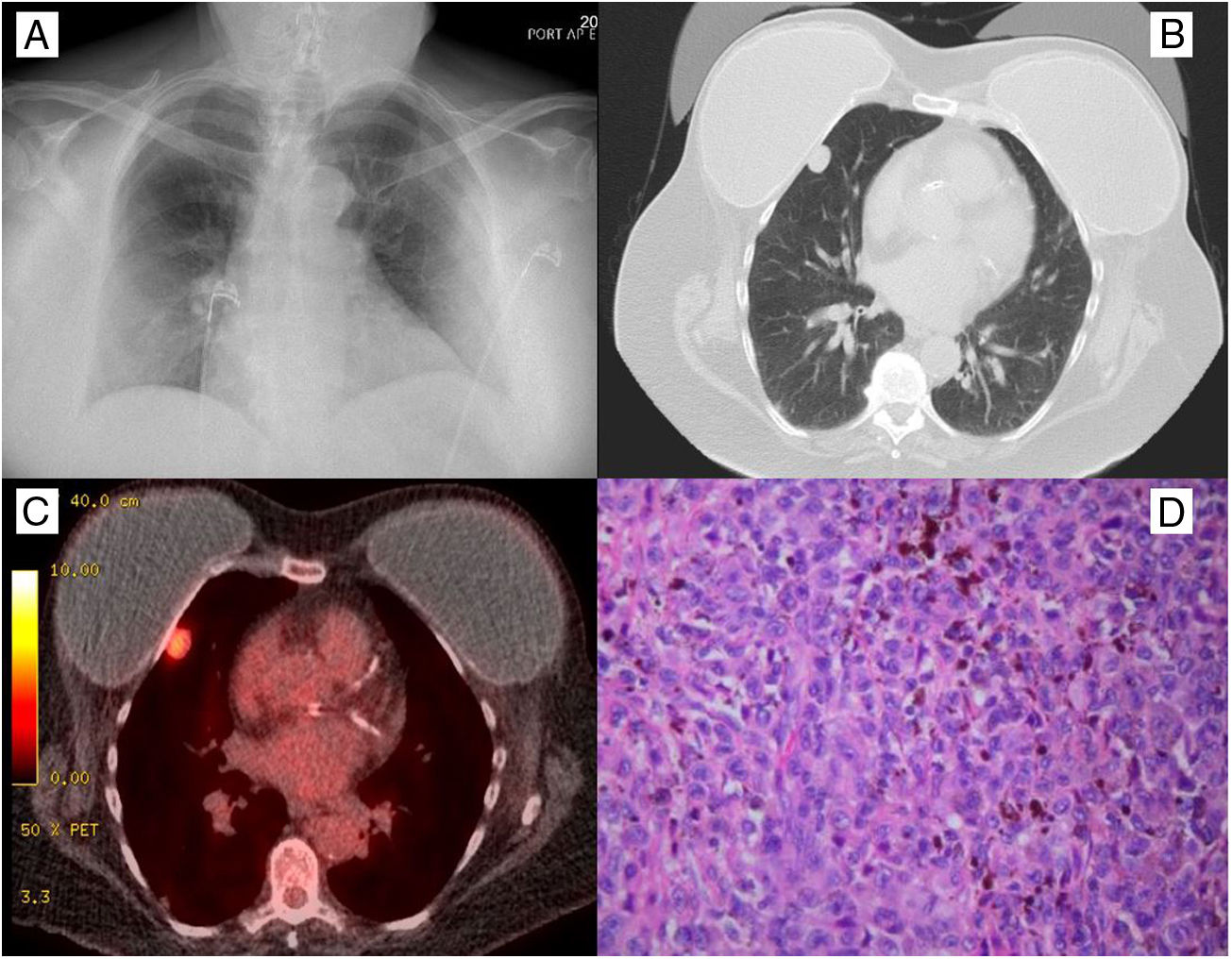 primary lung lesion