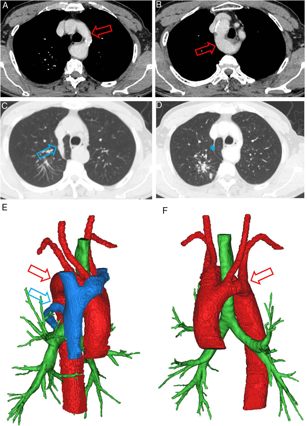 Double Aortic Arch and a Coexistent Azygos Lobe | Archivos de ...