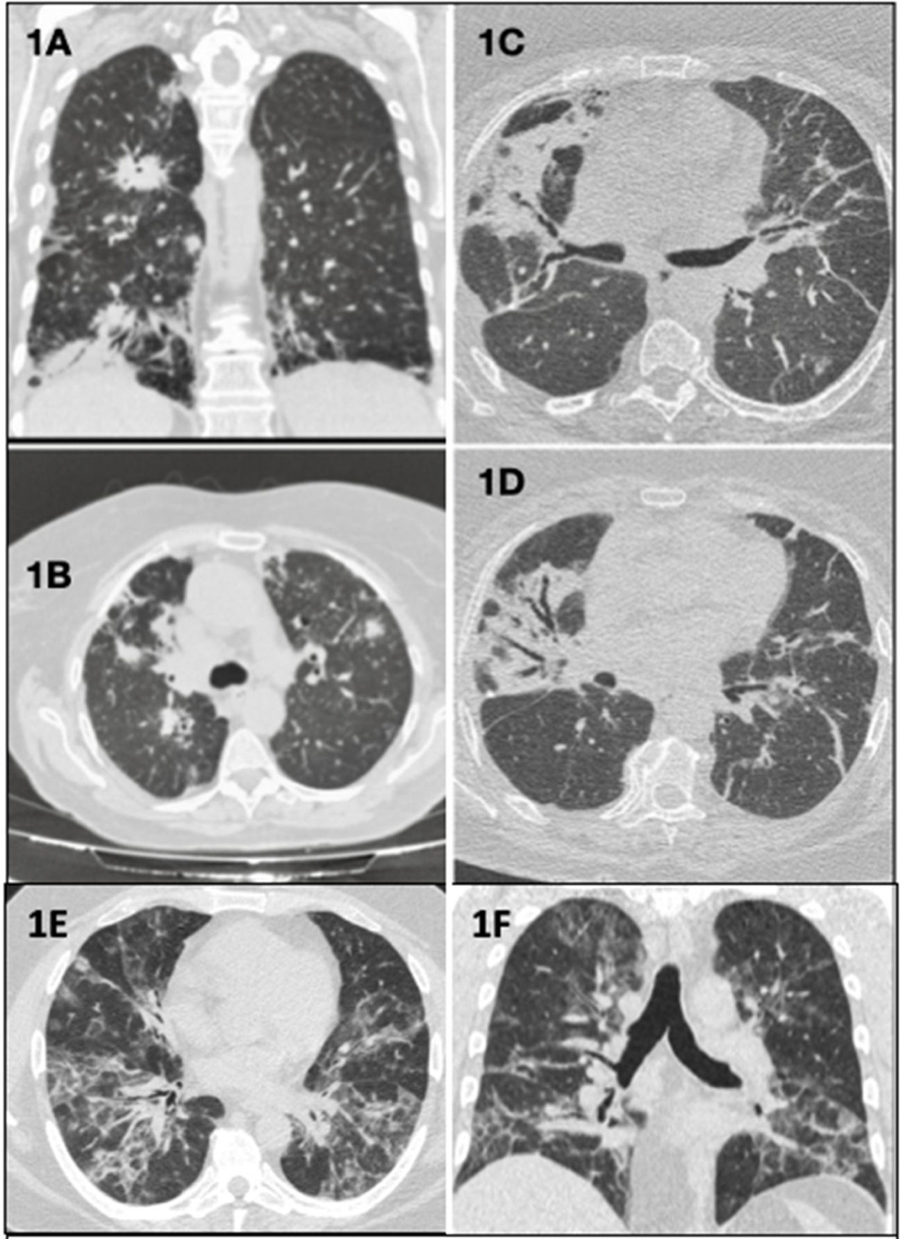 [Translated article] Radiological Manifestations of a Rare and ...