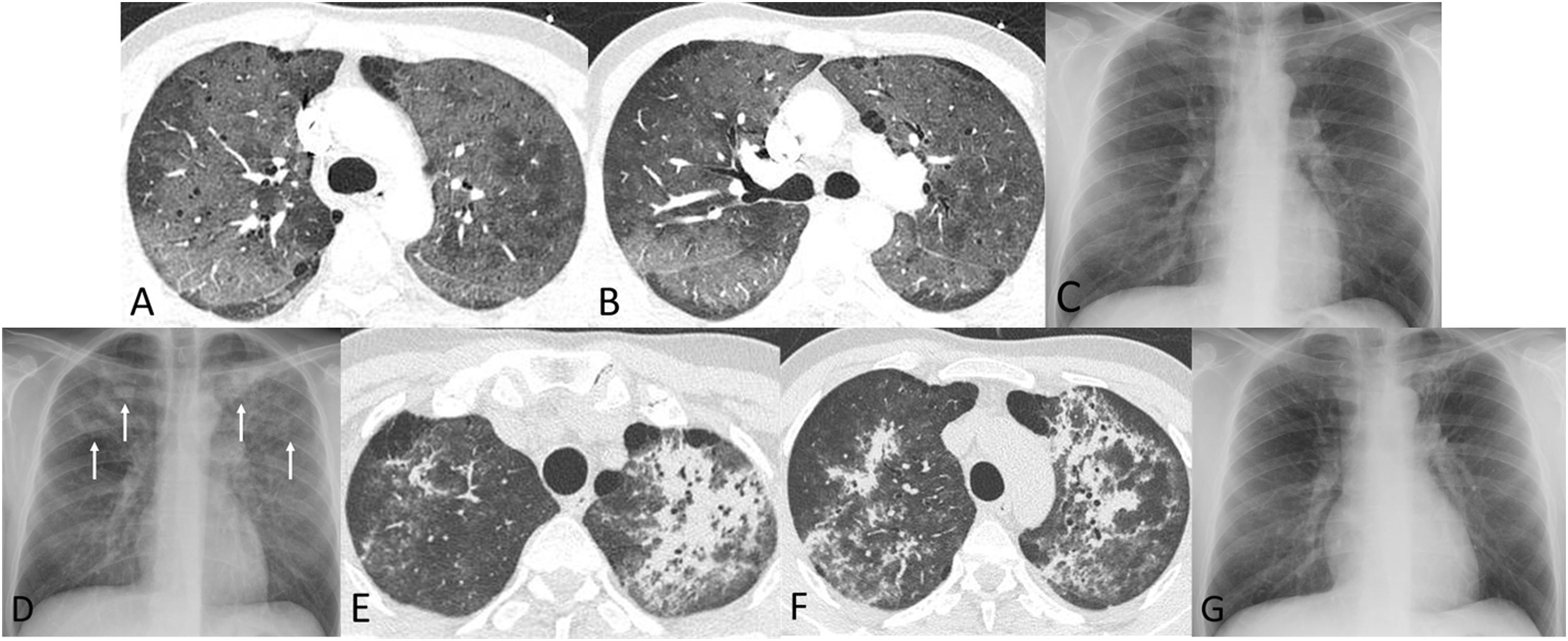 Pneumocystis jirovecii-Immune Reconstitution Inflammatory Syndrome ...