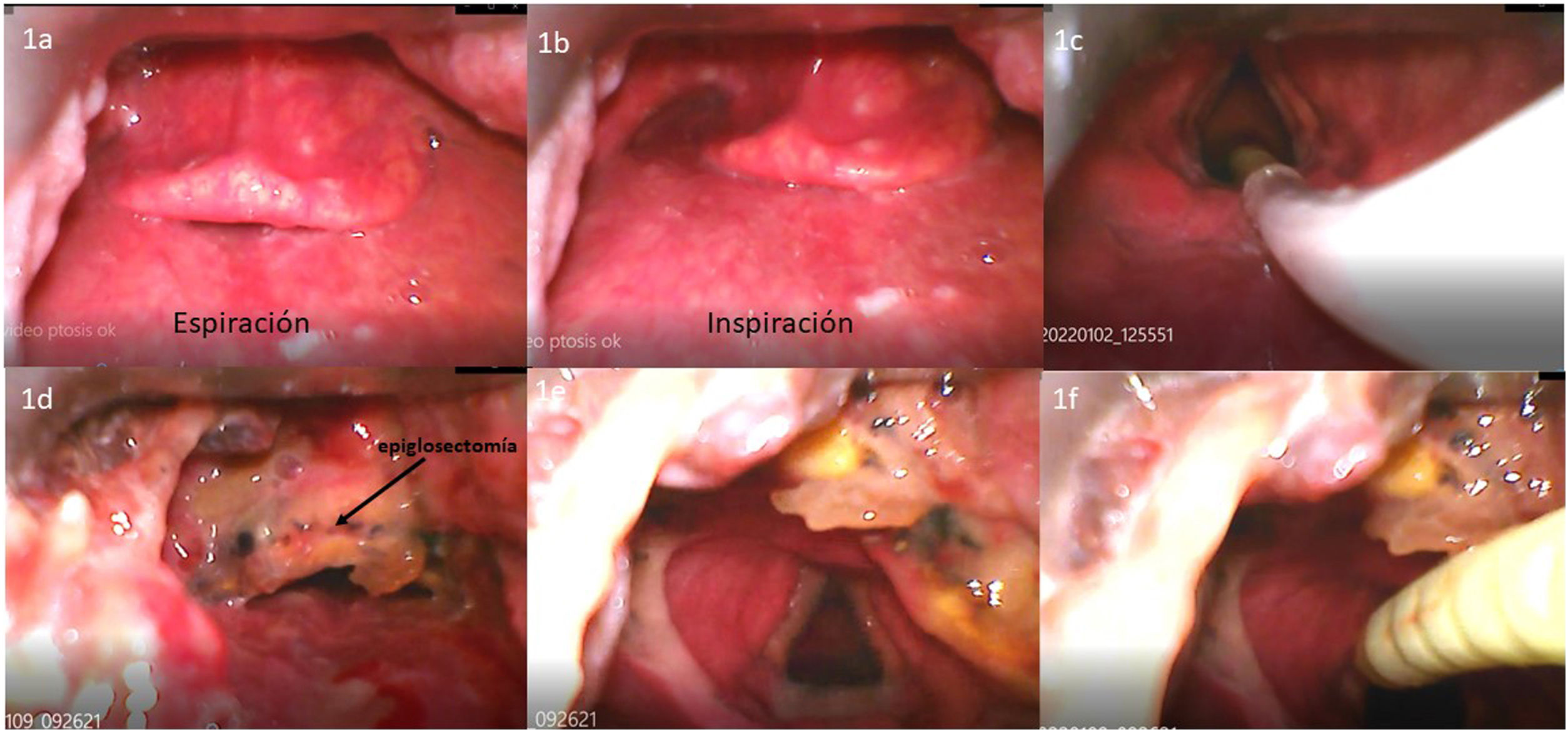 intubation view