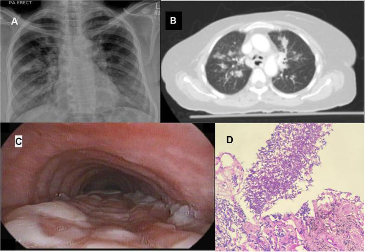 Invasive Aspergillosis and Pseudomembranous Tracheitis in Uncontrolled ...