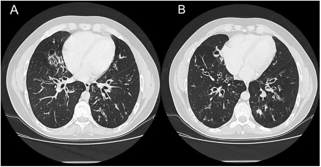 Bardet–Biedl Syndrome: An Uncommon Cause of Bronchiectasis | Archivos ...