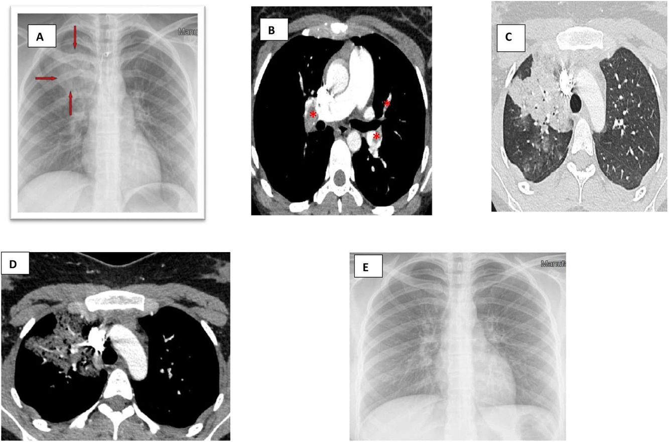 Concurrent Localized Pulmonary Edema in a Patient With Pulmonary ...