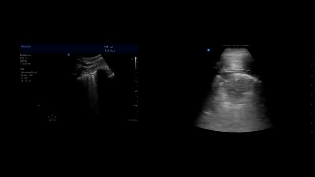Lung Ultrasound in ARDS: B-lines Pattern and Shred Sign | Archivos de ...