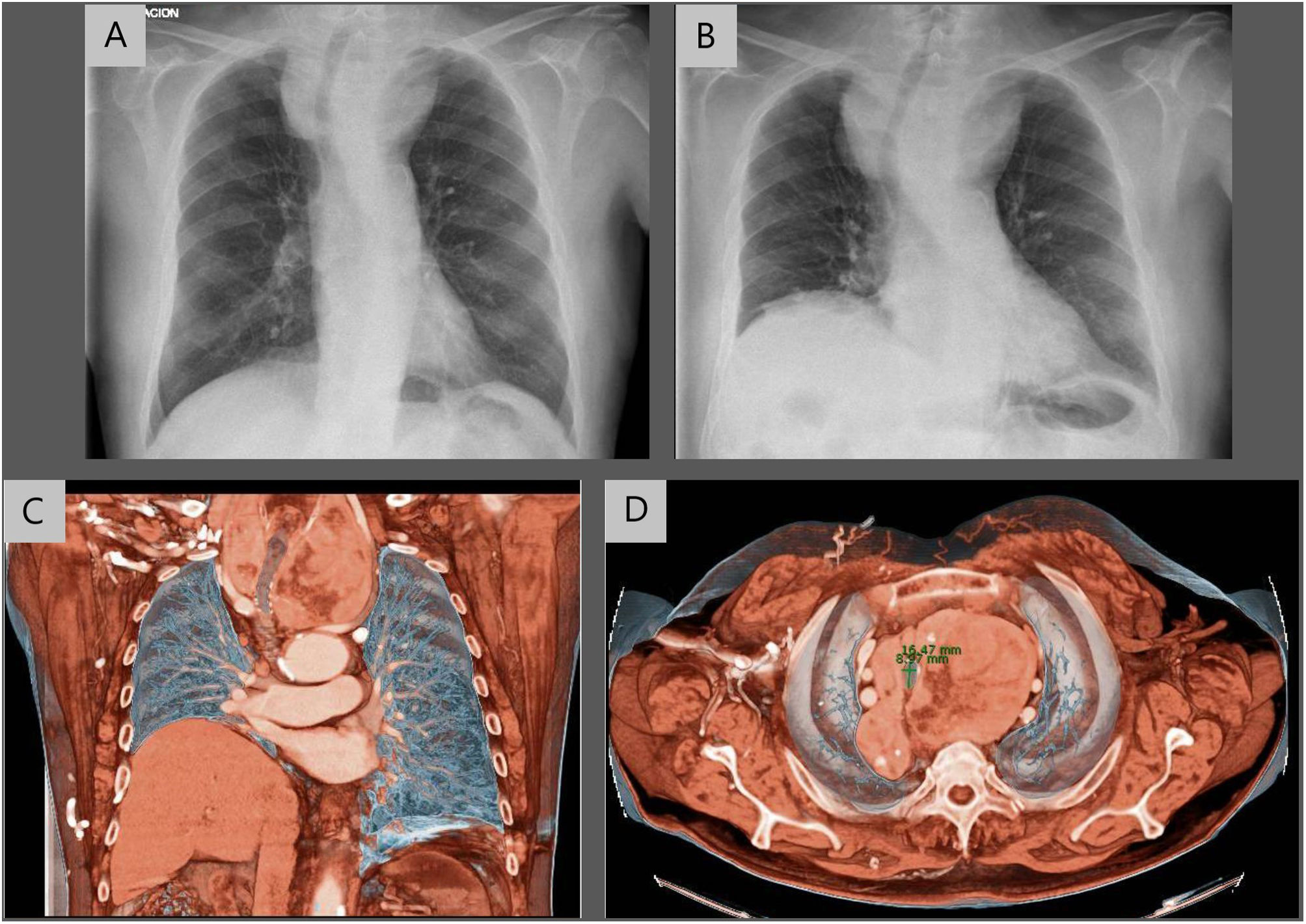 tracheal deviation