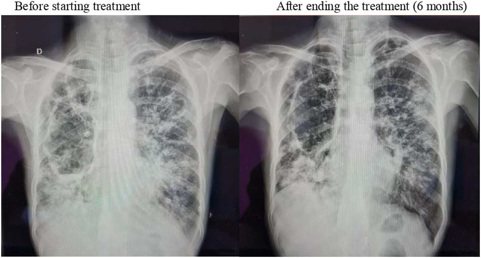 Multi-Drug Resistant Tuberculosis With Extensive Bilateral Lung ...