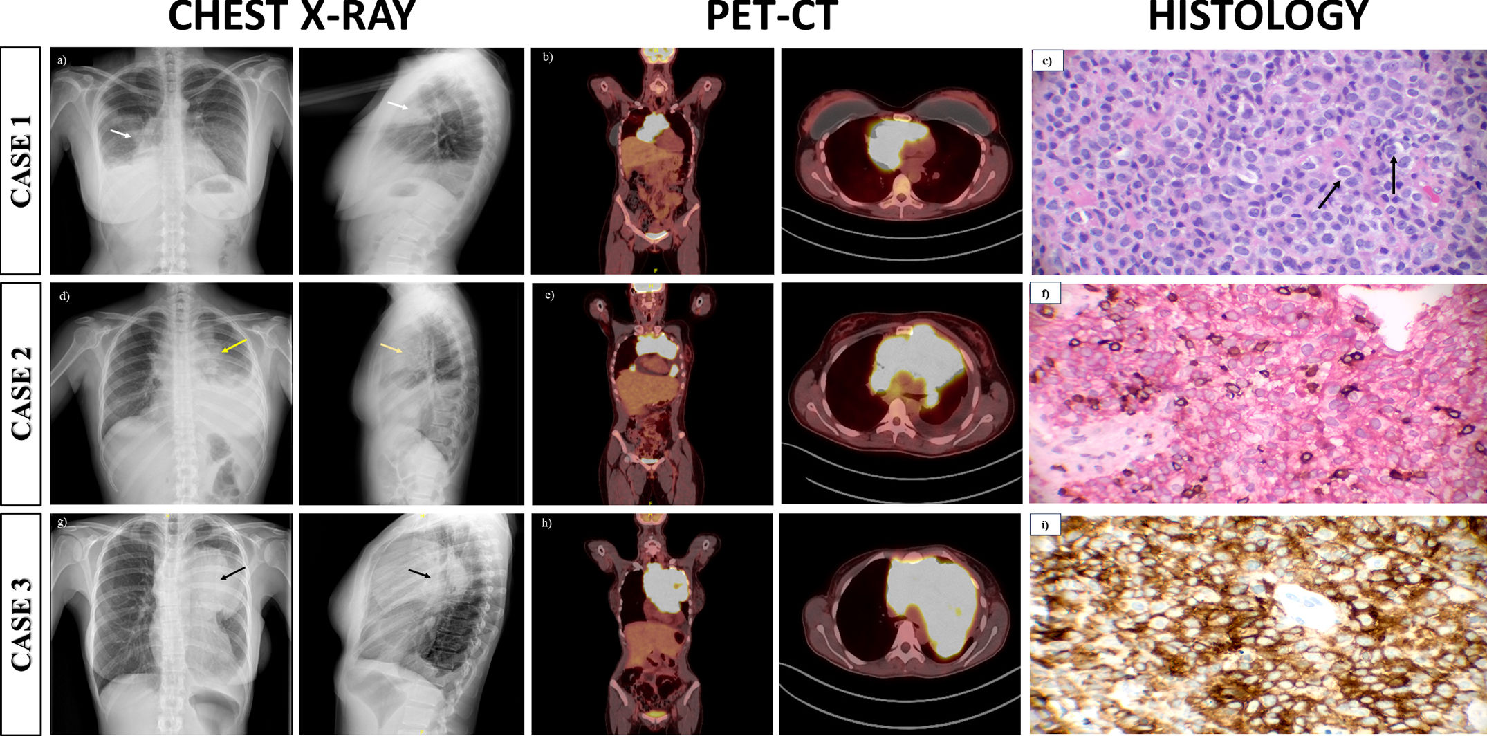 Gray Zone Lymphoma: The Overlap Between Hodgkin's and Non-Hodgkin's ...