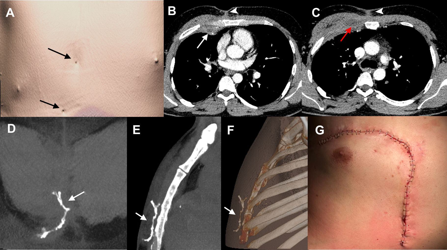 Chest Wall CT-Fistulography for Surgical Planning in a Patient With ...