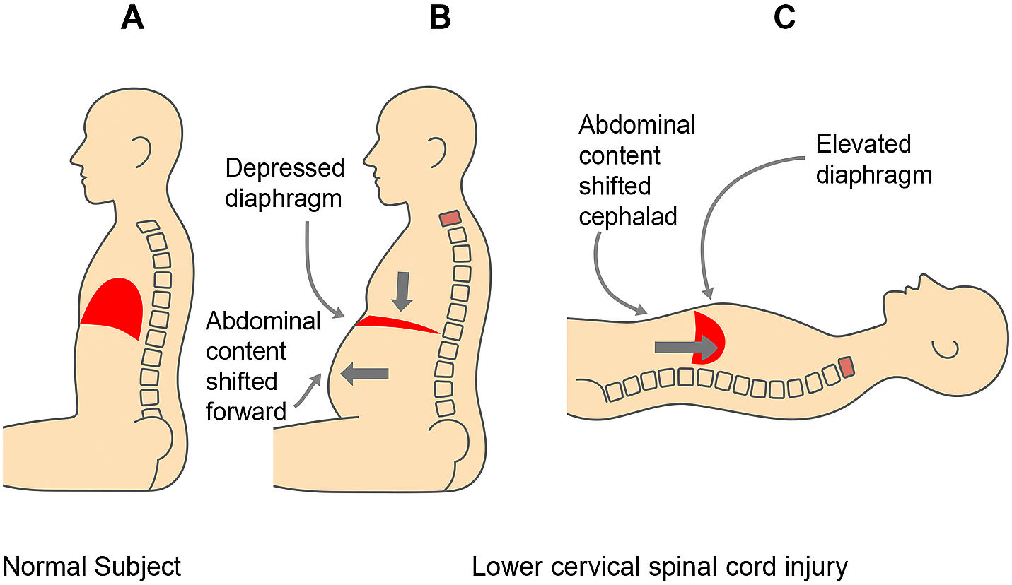 Recognizing Disproportionate Respiratory Muscle Weakness: Clinical ...