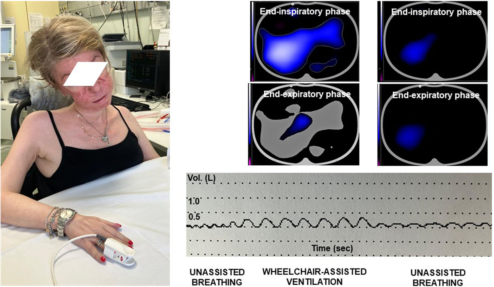 Wheelchair-assisted Ventilation in Neuromuscular Disease: The Abdominal ...