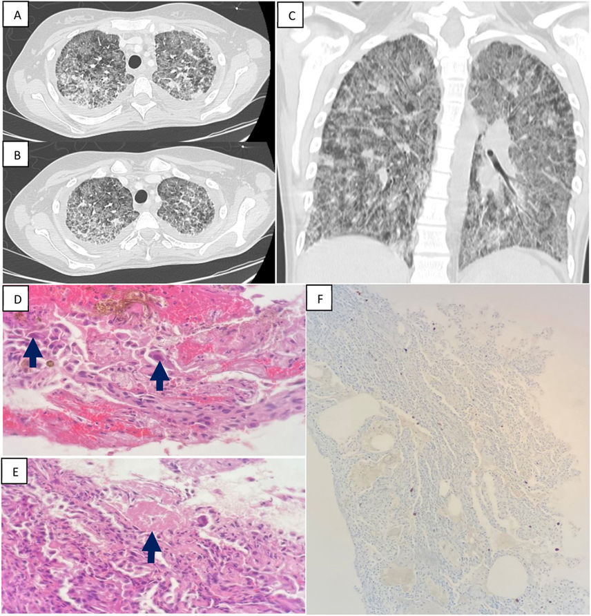 Pulmonary Alveolar Proteinosis and CMV Infection—An Uncommon ...