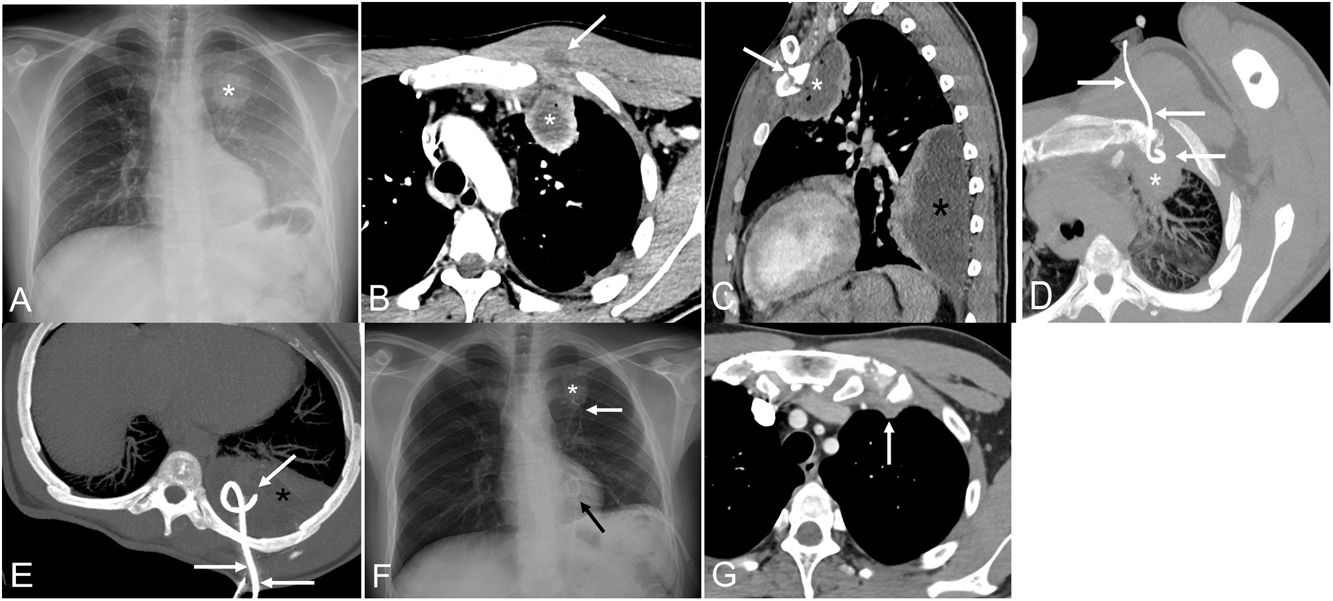 Septic Sternochondral Arthritis of the First Rib Complicated With ...