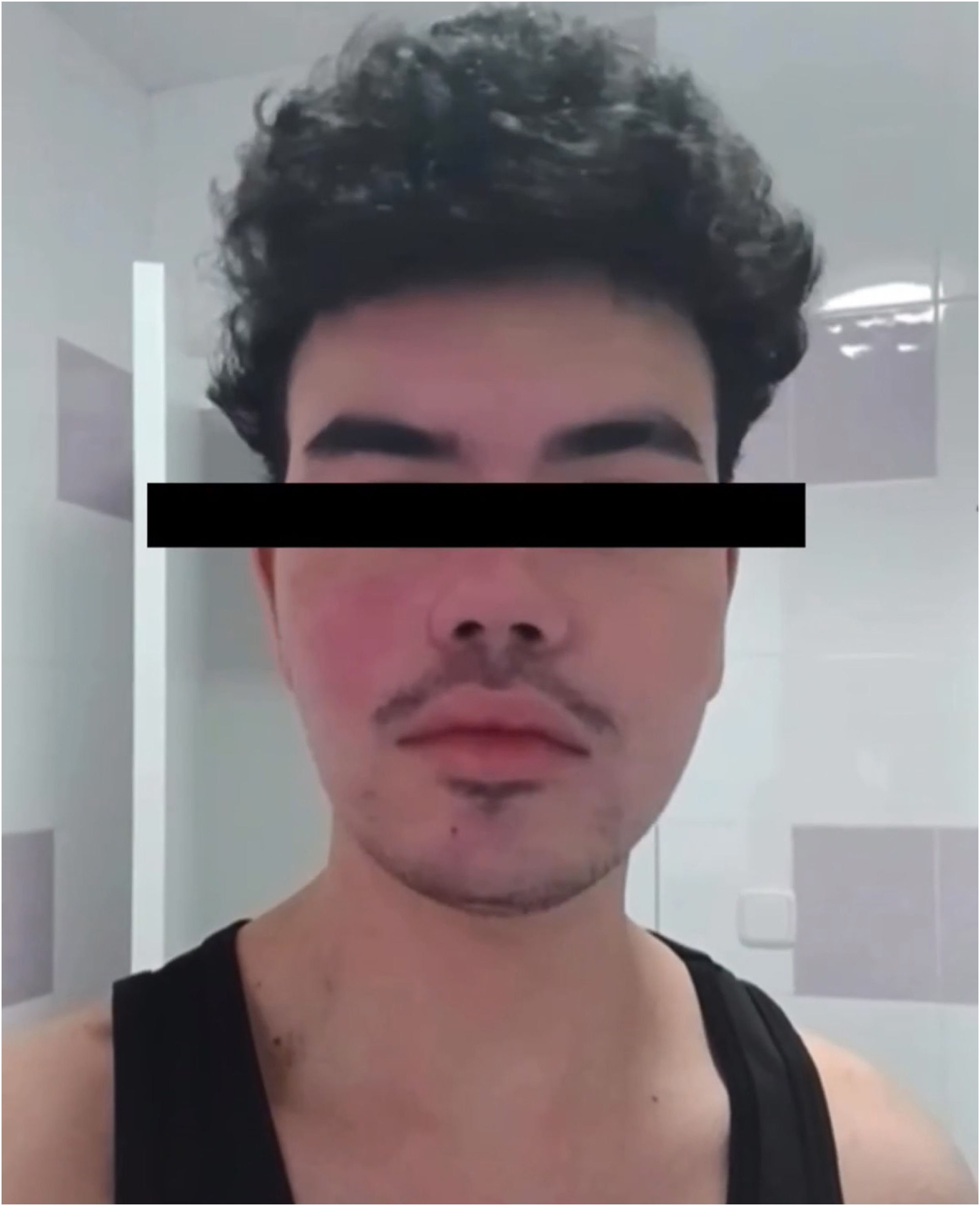 Facial Blushing Treated by Thoracic Sympathectomy: Visual Evidence ...