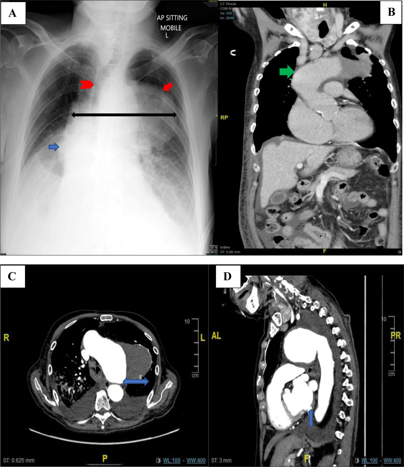 Syphilitic Aortitis: A Mimicker of Mediastinal Mass | Archivos de ...
