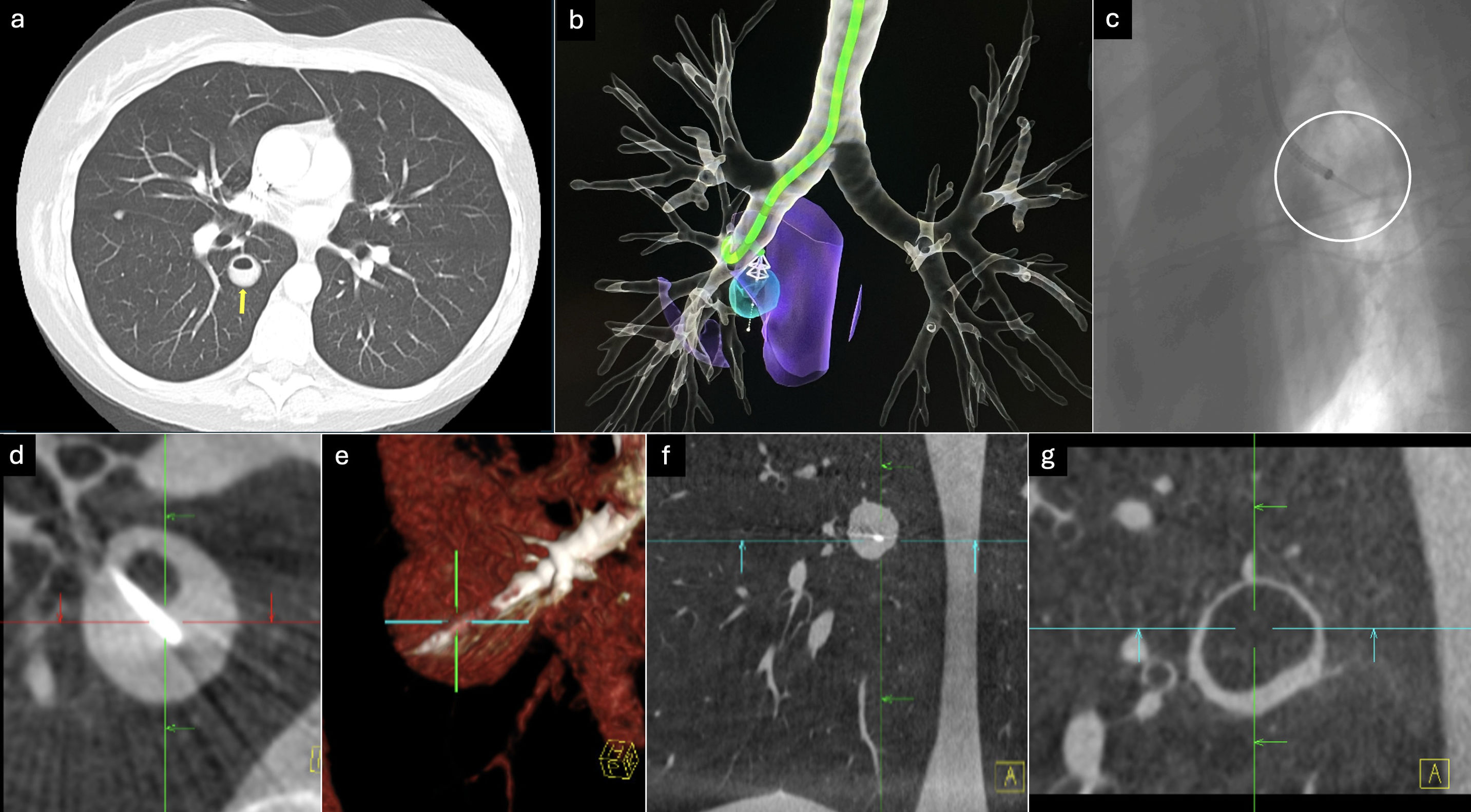 Small Lung Abscess Drainage Through Robotic-Assisted Bronchoscopy and ...