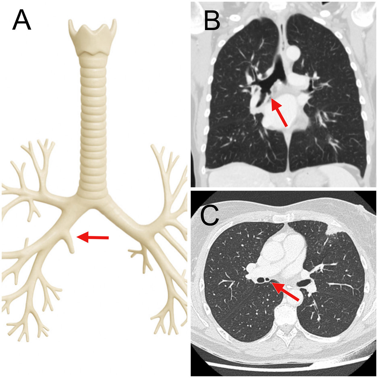 Right Cardiac Bronchus: An Uncommon Incidental Finding | Archivos de ...