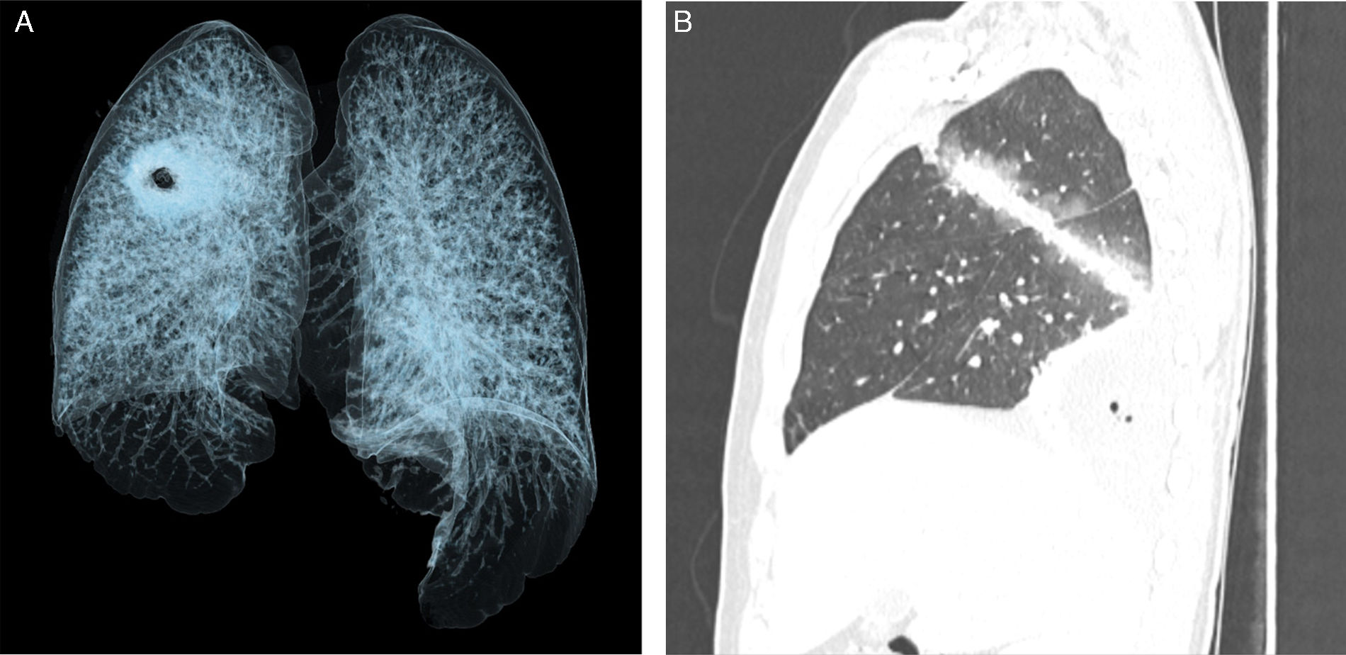 Penetrating Thoracic Trauma: Computed Tomography Depiction of a Bullet ...