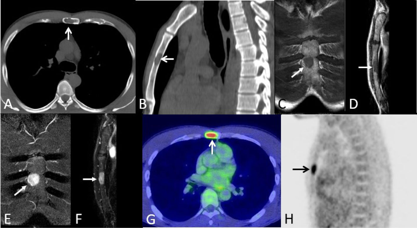 Incidental Finding of a Solitary Sternal Plasmacytoma Detected at Lung ...