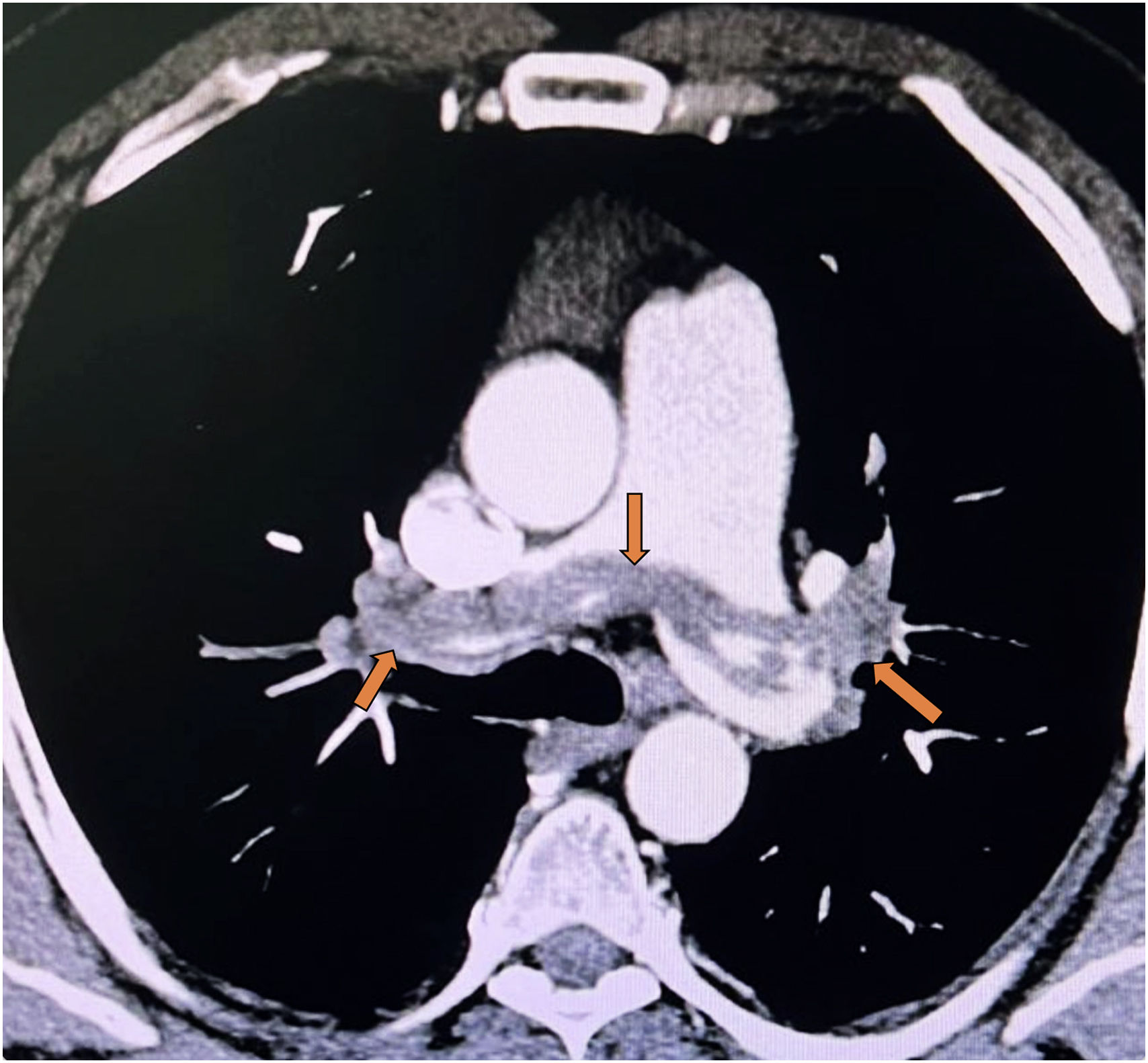 Saddle Pulmonary Embolism in Hemodynamically Stable Patients: Clinical ...