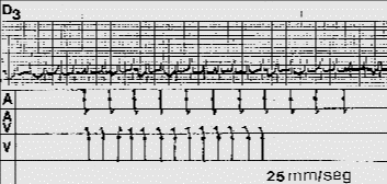 Taquicardia ectópica congénita de la unión auriculoventricular ...