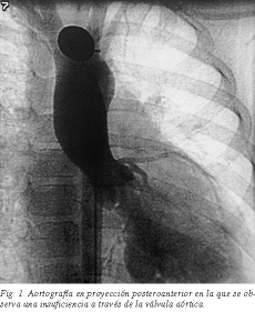 Tratamiento quirúrgico de la estenosis aórtica crítica en el niño ...
