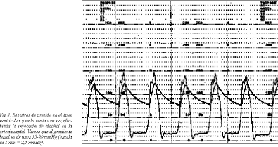 Inducción de infarto septal como alternativa terapéutica en la ...