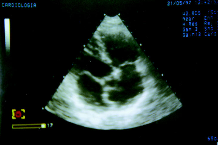 Aneurismas del tabique interauricular. Presentación de tres casos ...