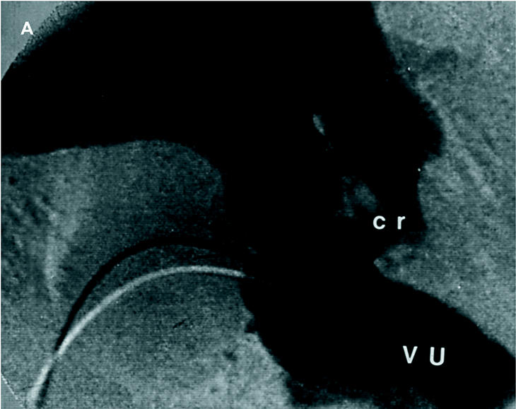 Ventrículo único de morfología izquierda corregido a los 49 años con ...