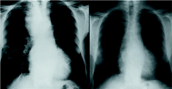 Sífilis cardiovascular: a propósito de un caso | Revista Española de ...