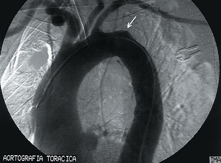 Imagen Angiográfica En Un Caso De úlcera Penetrante De Aorta Revista