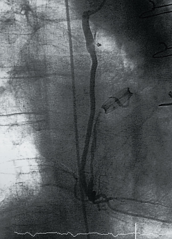 Acodamiento de un injerto de safena: imagen angiográfica | Revista ...