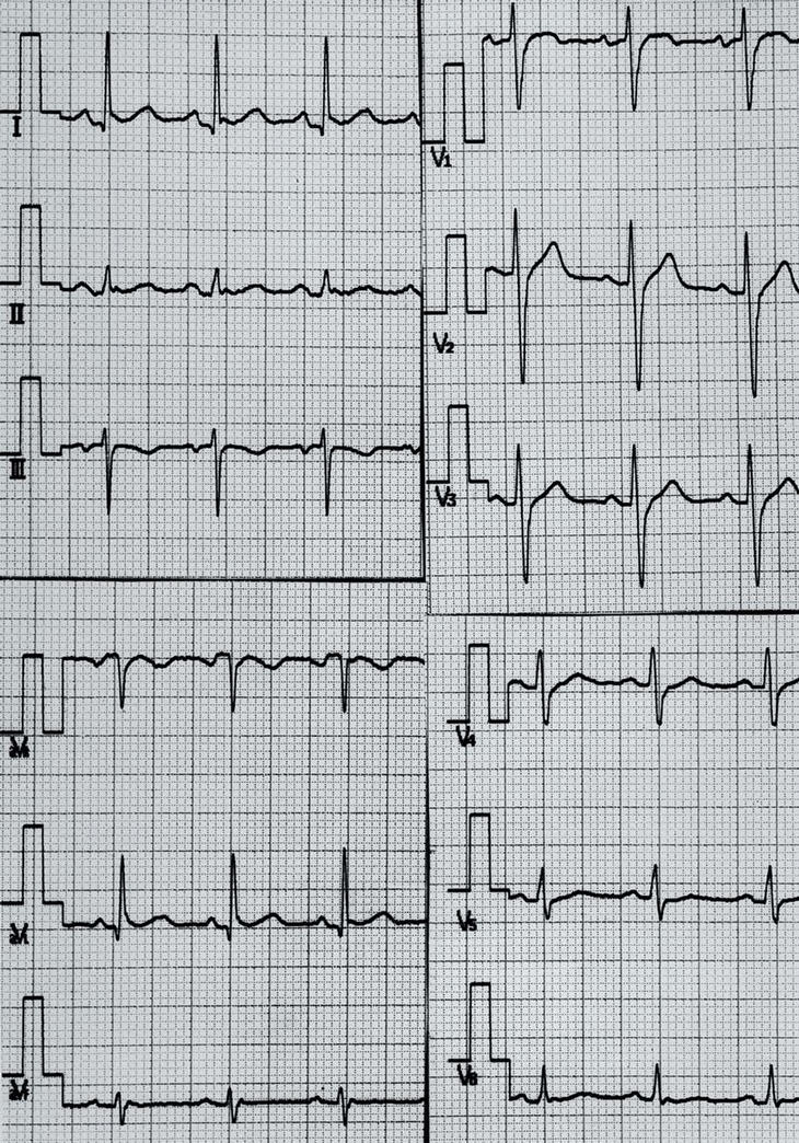 Bloqueo auriculoventricular completo transitorio tras traumatismo ...